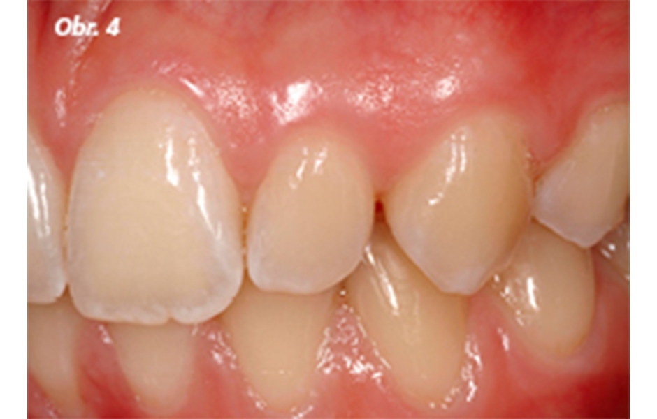 „Non-prep“ adhezivní dostavby: řešení estetických nedostatků ...