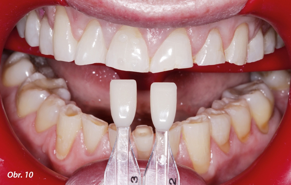 Excelentní výsledek minimálně invazivní rekonstrukce opotřebených zubů ...