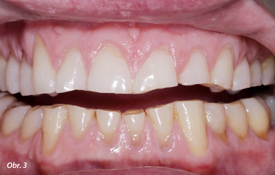 Excelentní výsledek minimálně invazivní rekonstrukce opotřebených zubů ...